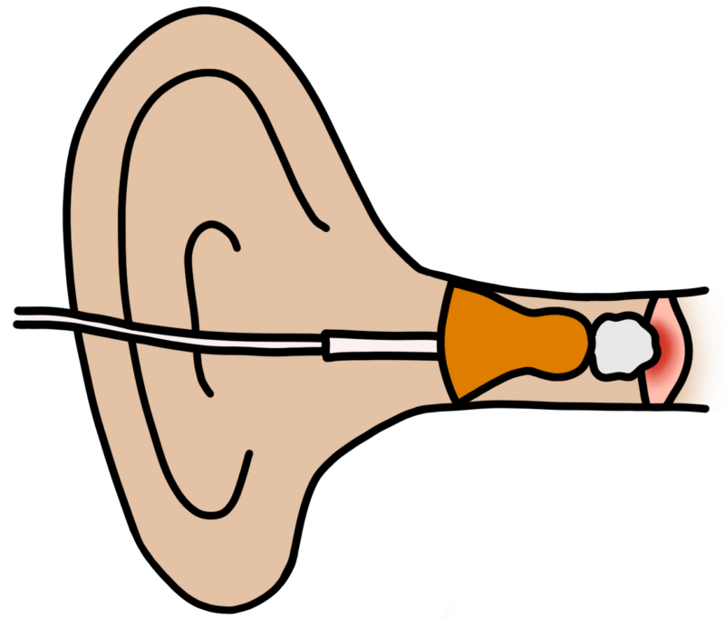 Tympanic probe Temperature Sensors - Starboard Medical